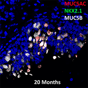 20 Month Human MUC5AC, NKX2.1, and MUC5B Confocal Imaging