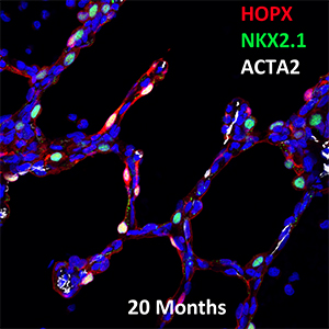20 Month Human HOPX, NKX2.1, and ACTA2 Confocal Imaging